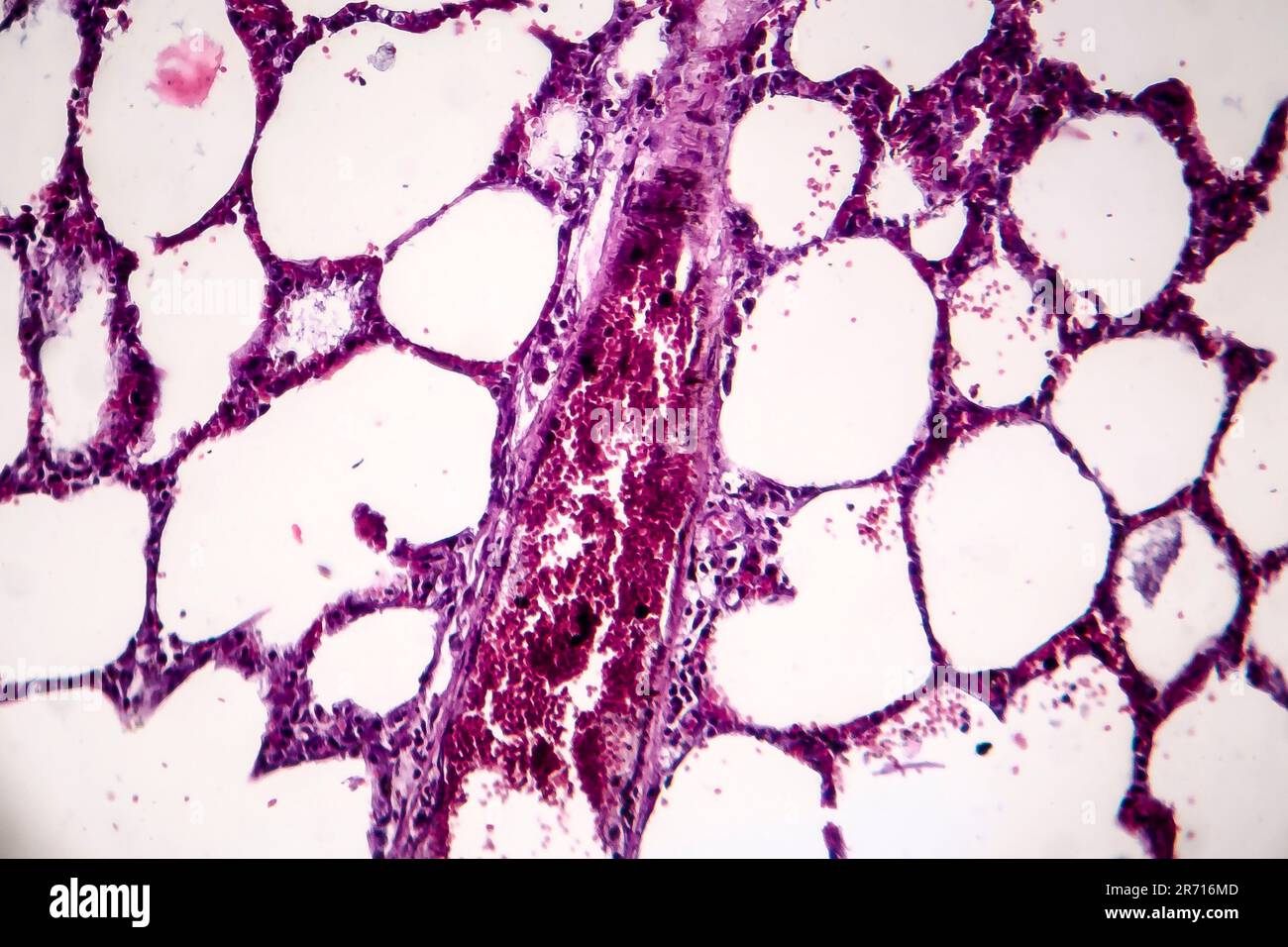 Histopathology of pneumonia, light micrograph, photo under microscope ...