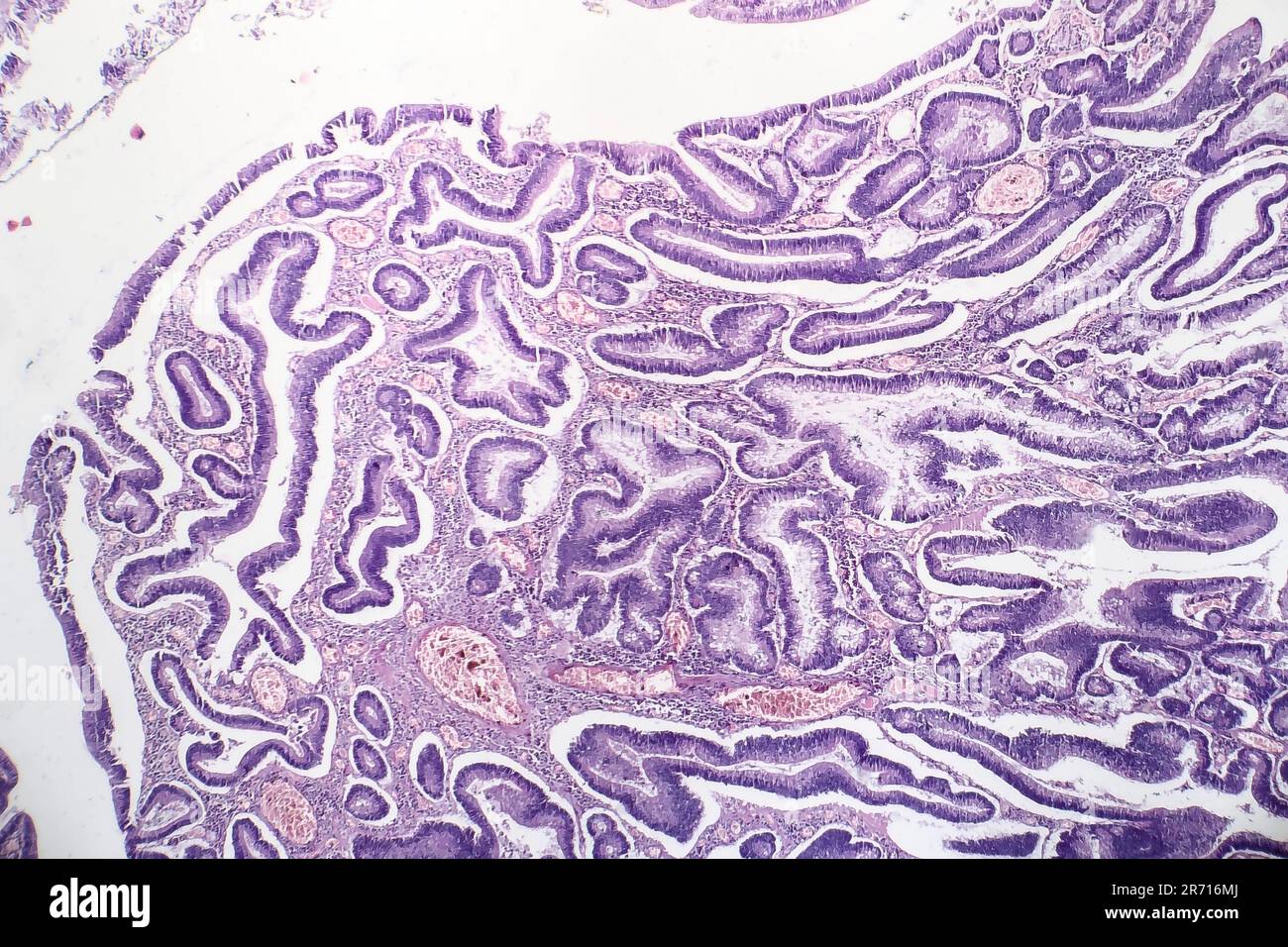 Histopathology of intestinal adenoma, light micrograph, photo under ...