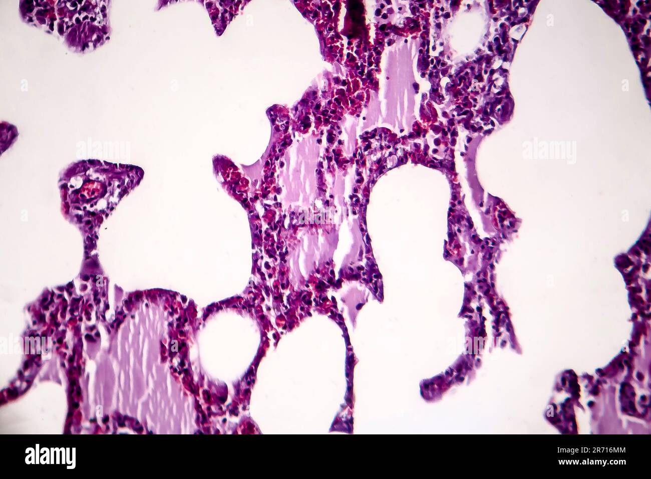 Histopathology of pneumonia, light micrograph, photo under microscope ...