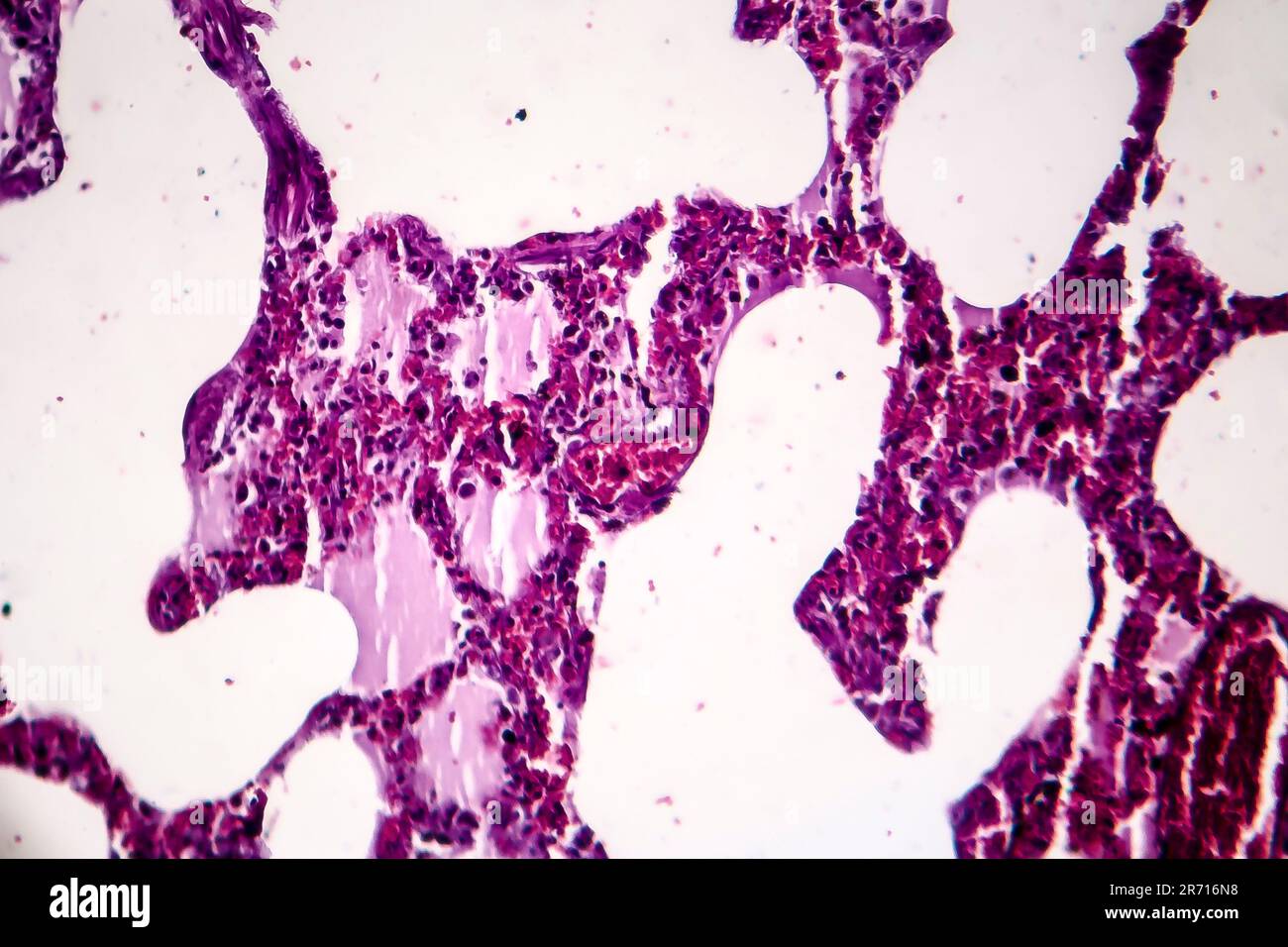 Histopathology of pneumonia, light micrograph, photo under microscope ...