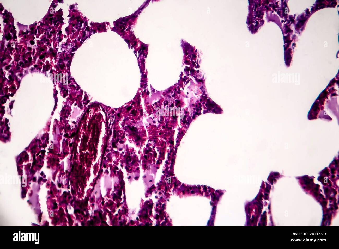 Histopathology of pneumonia, light micrograph, photo under microscope ...