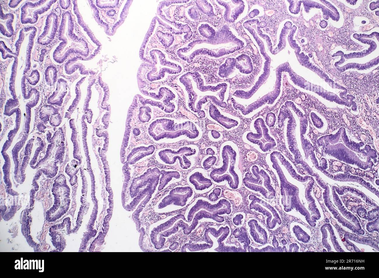 Histopathology of intestinal adenoma, light micrograph, photo under ...