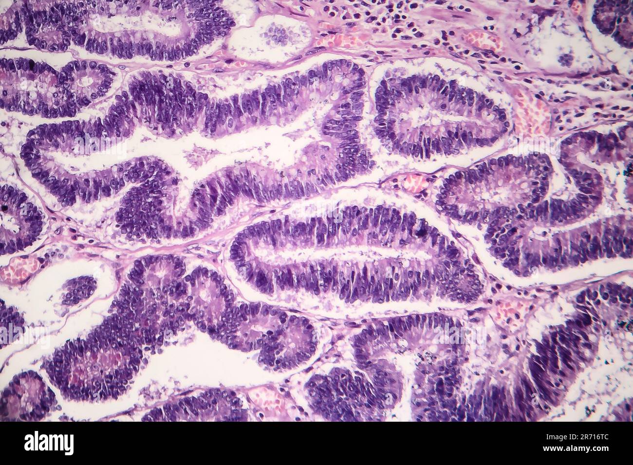 Histopathology of intestinal adenoma, light micrograph, photo under ...