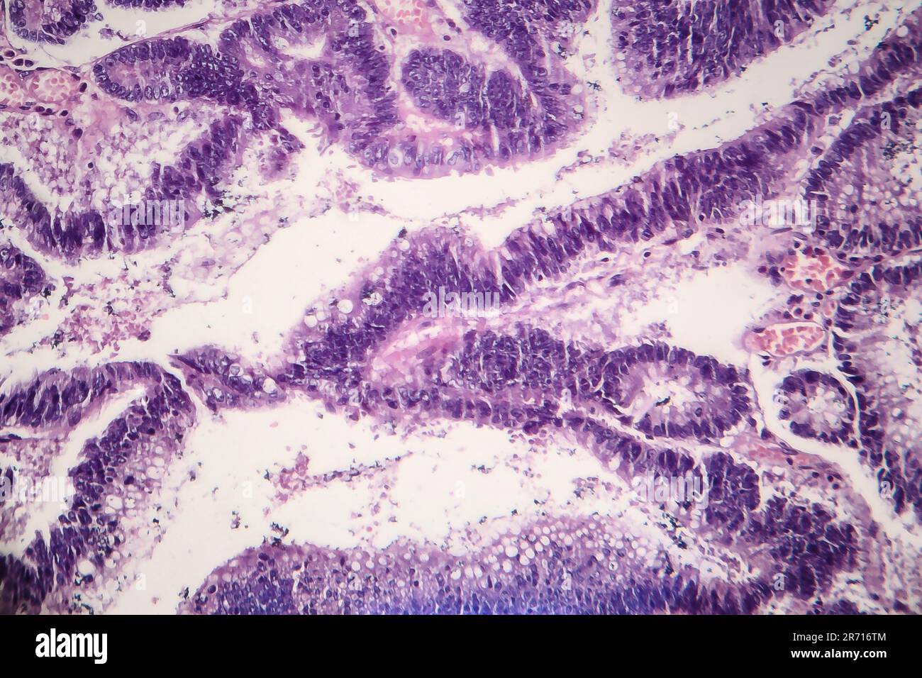 Histopathology of intestinal adenoma, light micrograph, photo under ...