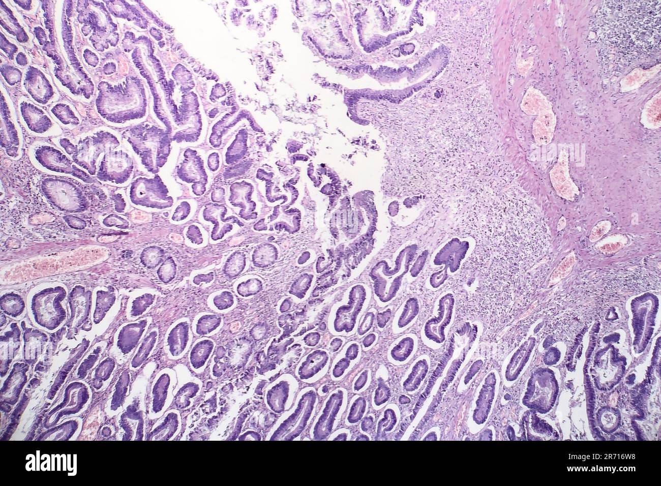 Histopathology of intestinal adenoma, light micrograph, photo under ...