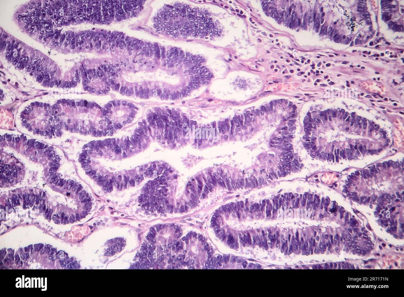Histopathology of intestinal adenoma, light micrograph, photo under ...