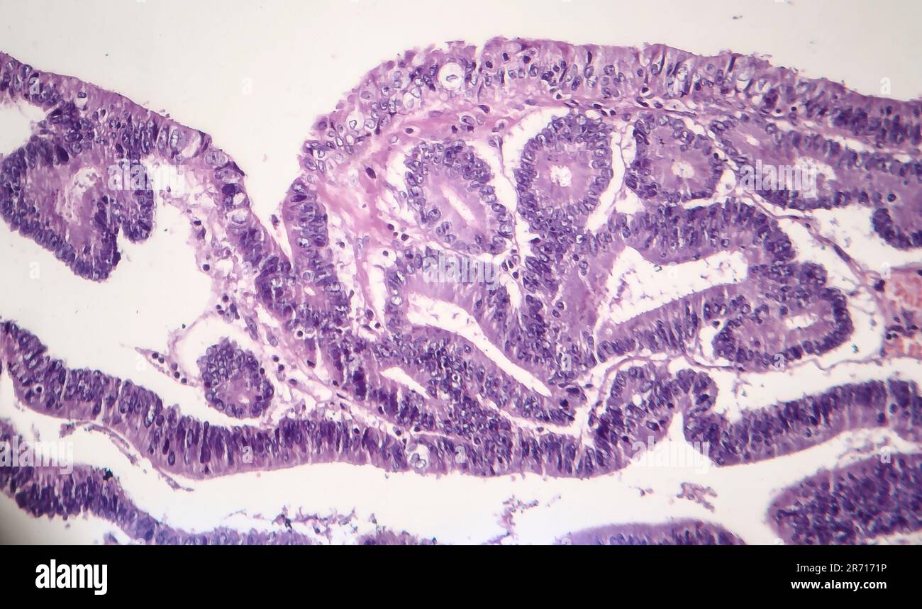 Histopathology of intestinal adenoma, light micrograph, photo under ...