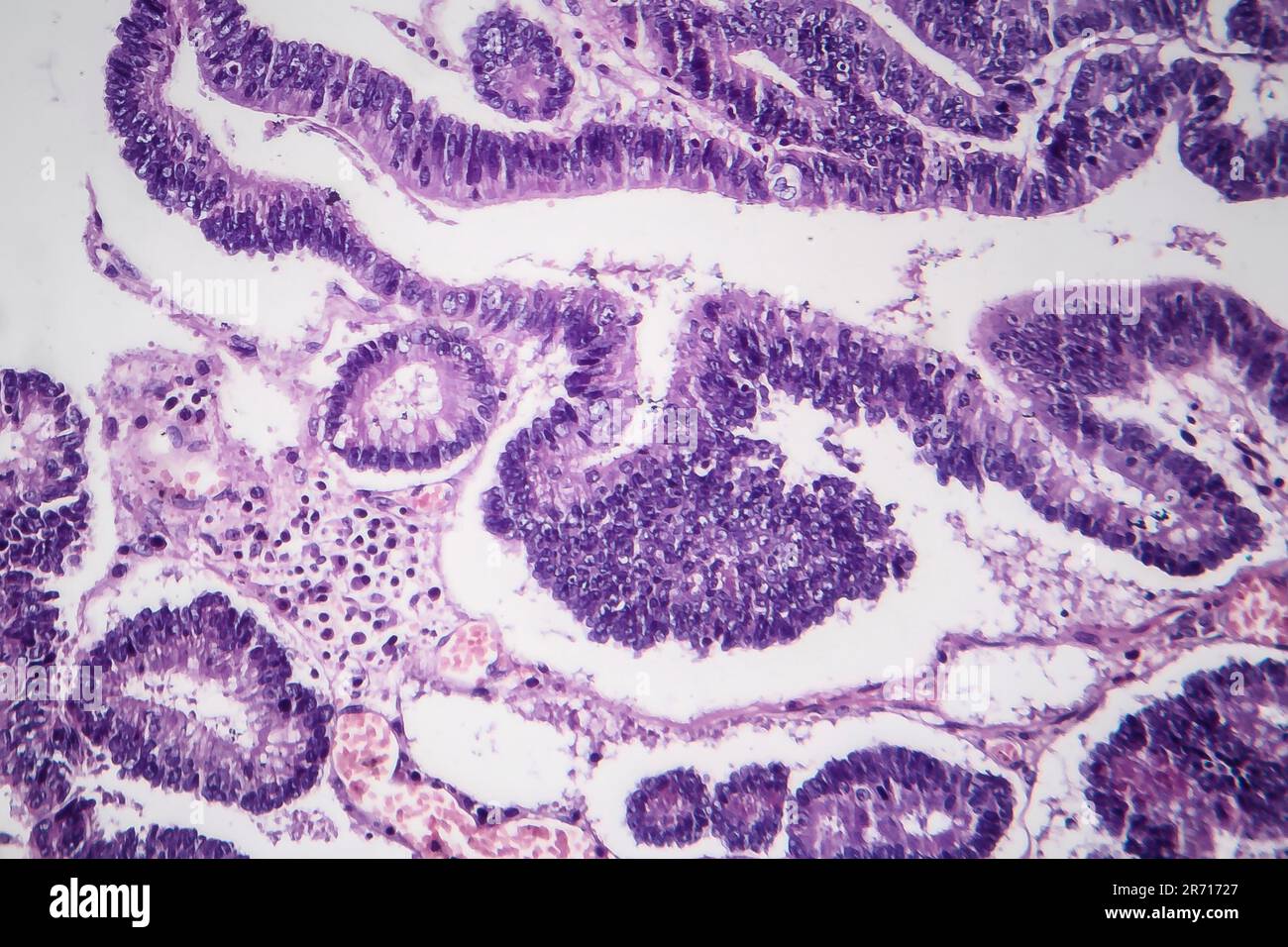 Histopathology of intestinal adenoma, light micrograph, photo under ...
