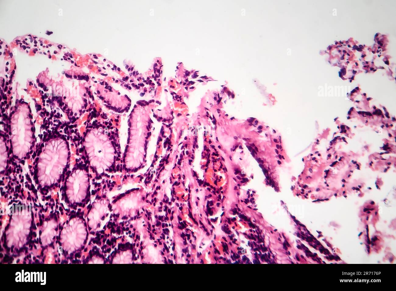 Histopathology of chronic atrophic gastritis, light micrograph, photo ...