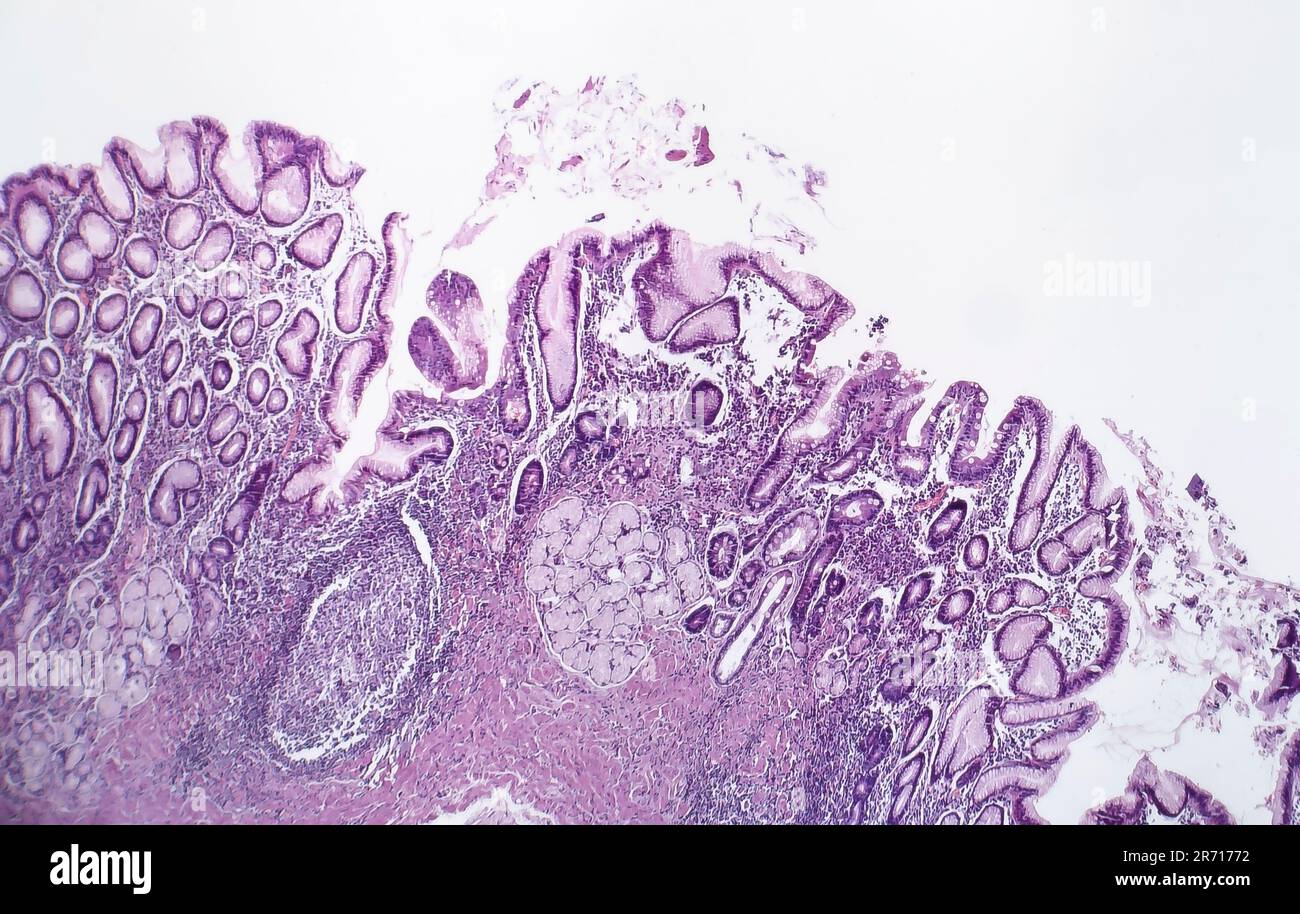 Histopathology of chronic superficial gastritis, light micrograph ...