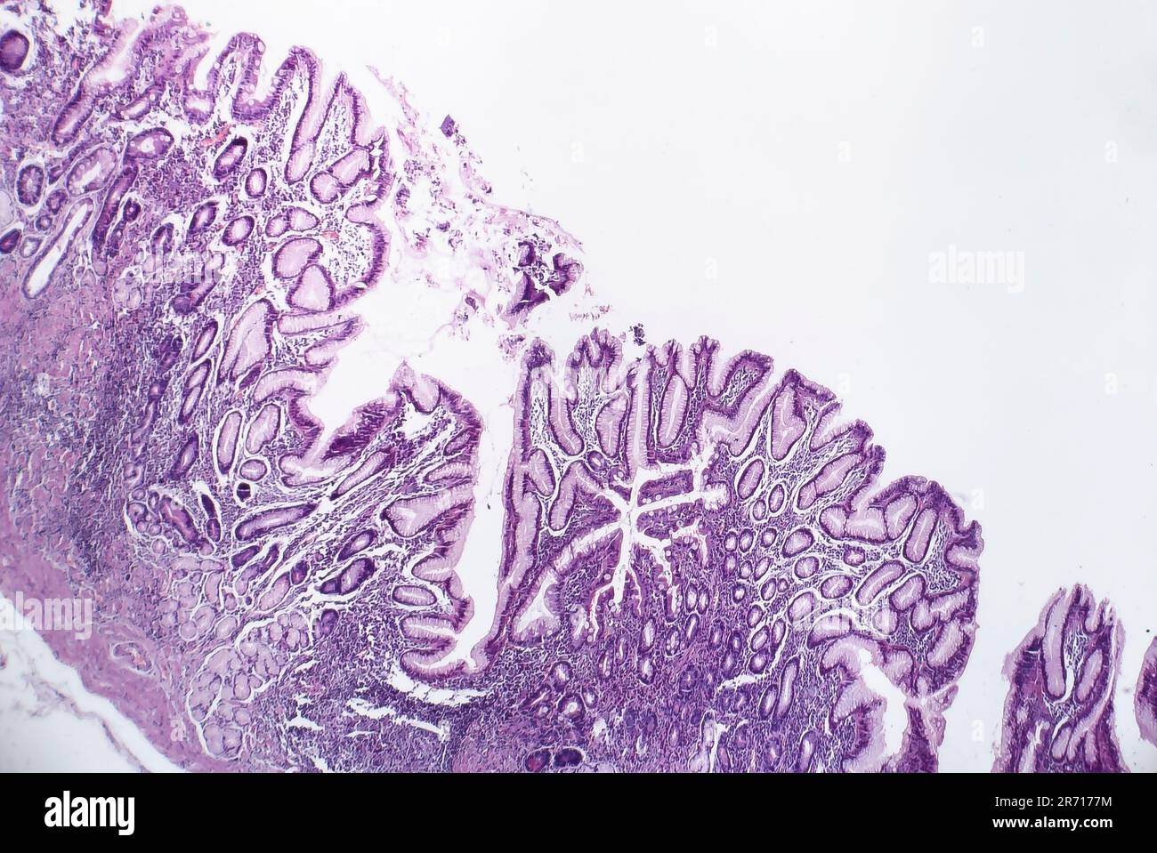 Histopathology of chronic superficial gastritis, light micrograph ...