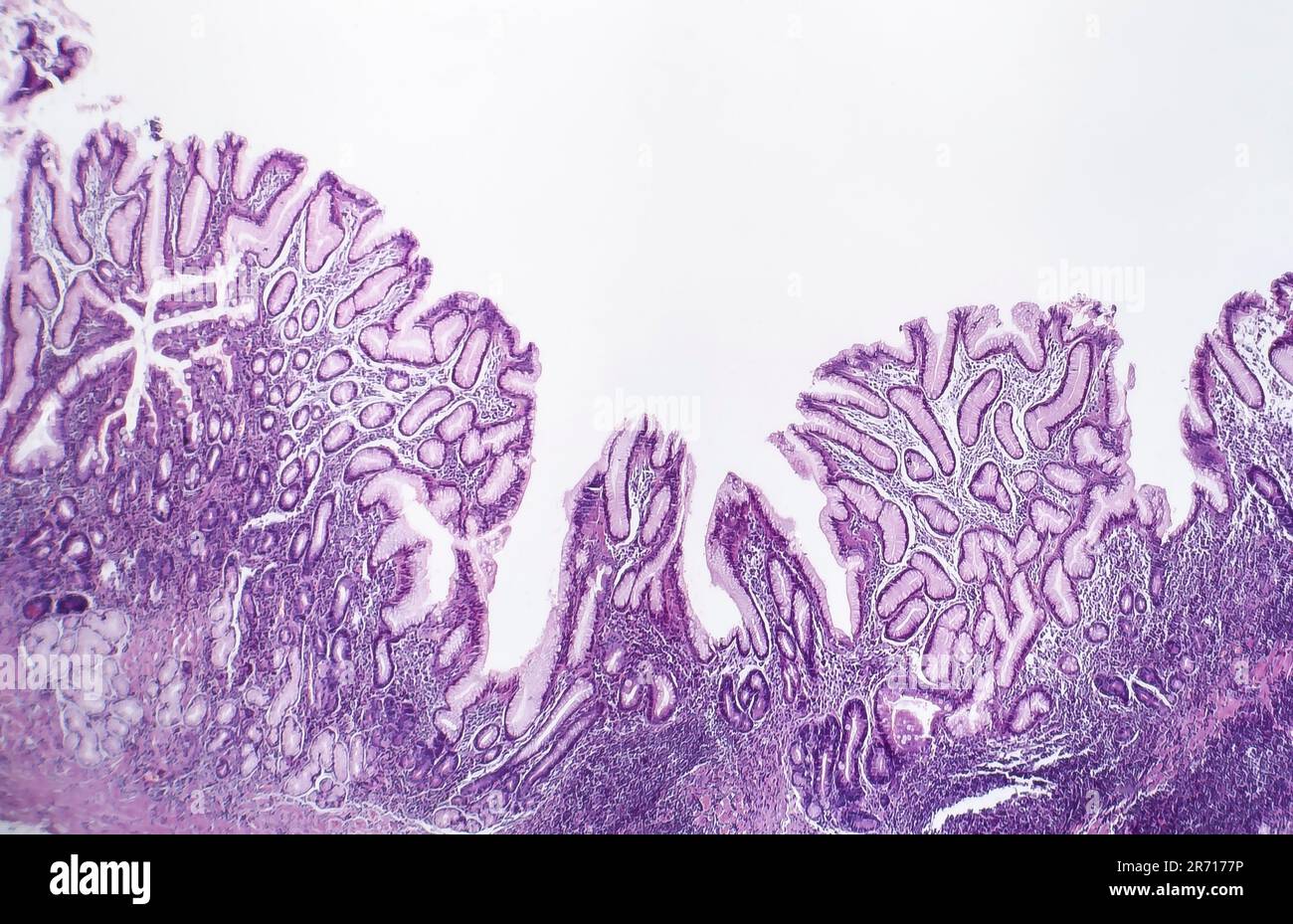 Histopathology of chronic superficial gastritis, light micrograph ...