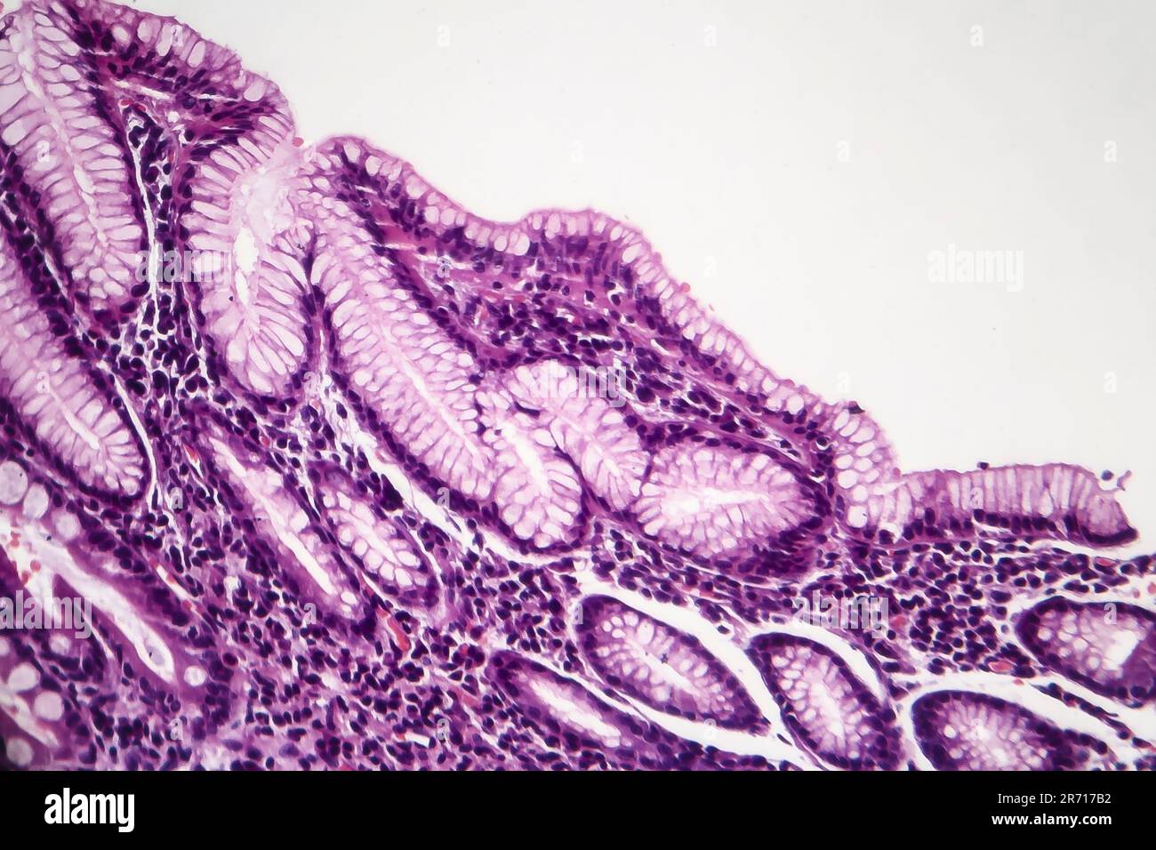 Histopathology of chronic superficial gastritis, light micrograph ...