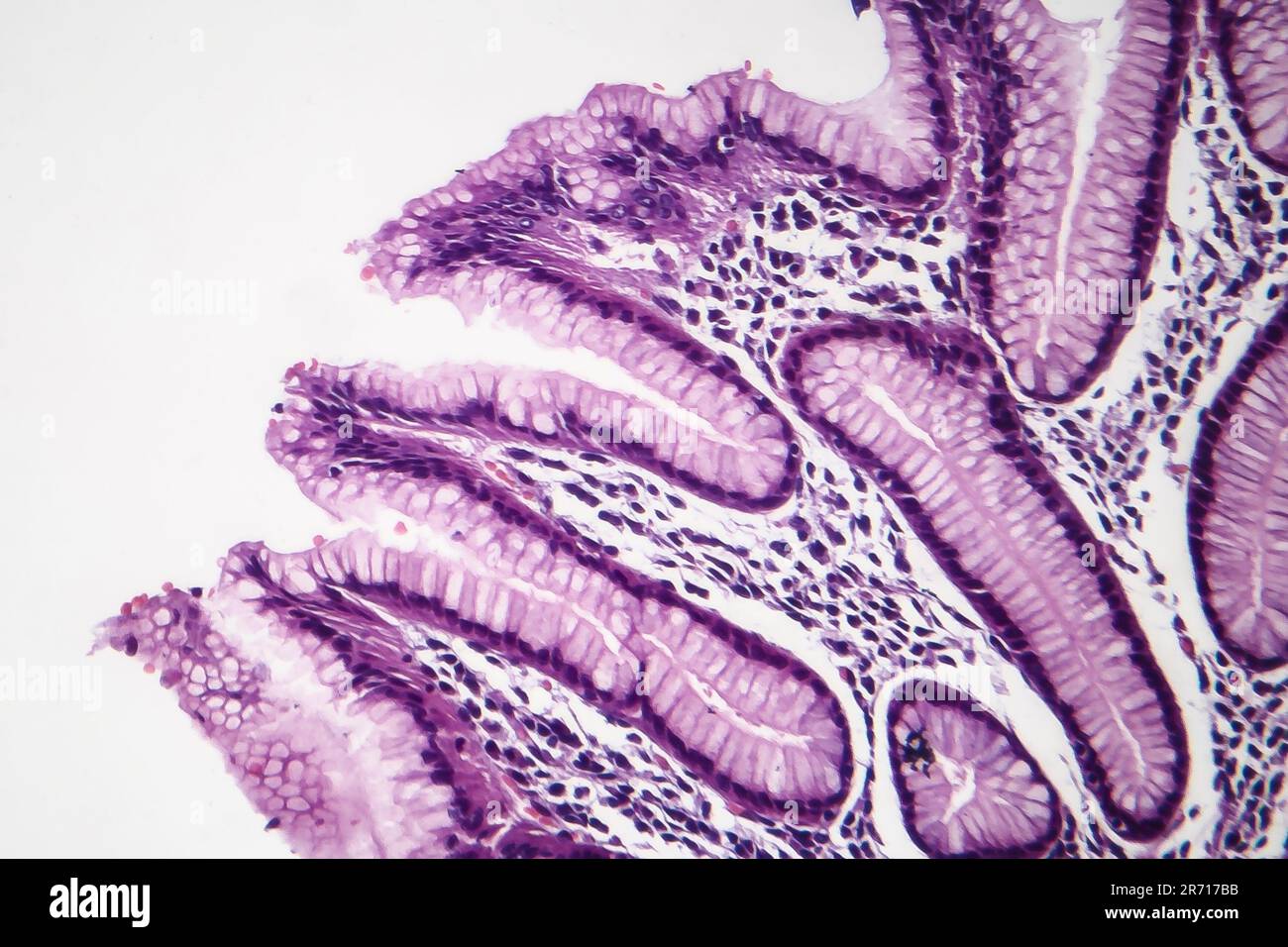 Histopathology of chronic superficial gastritis, light micrograph ...