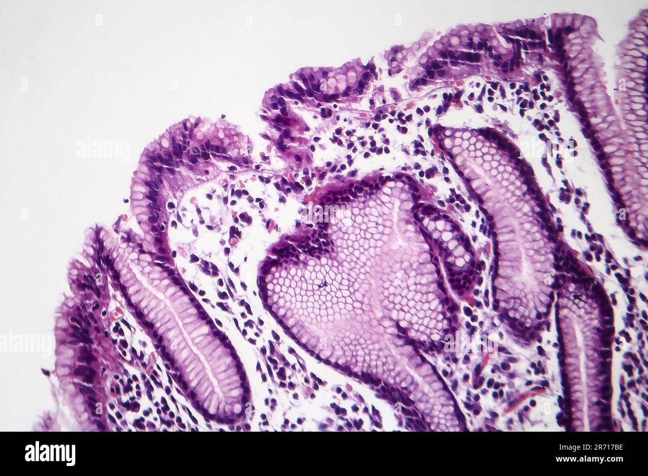 Histopathology of chronic superficial gastritis, light micrograph ...