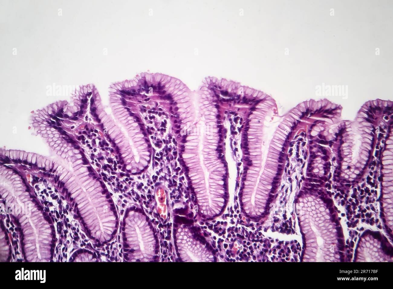 Histopathology of chronic superficial gastritis, light micrograph ...