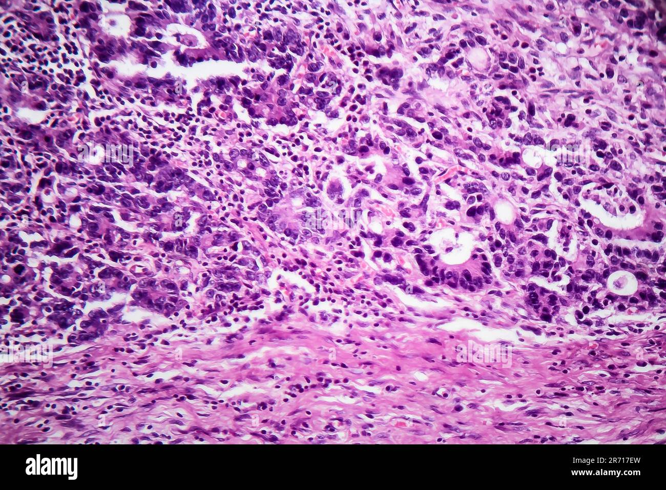 Gastric adenocarcinoma, light micrograph, photo under microscope Stock ...
