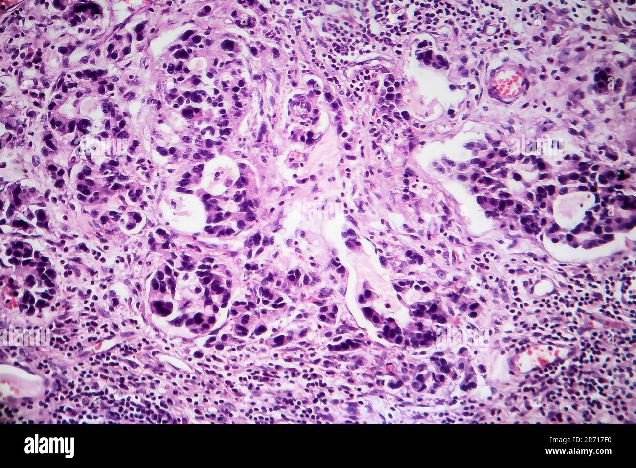 Gastric adenocarcinoma, light micrograph, photo under microscope Stock ...