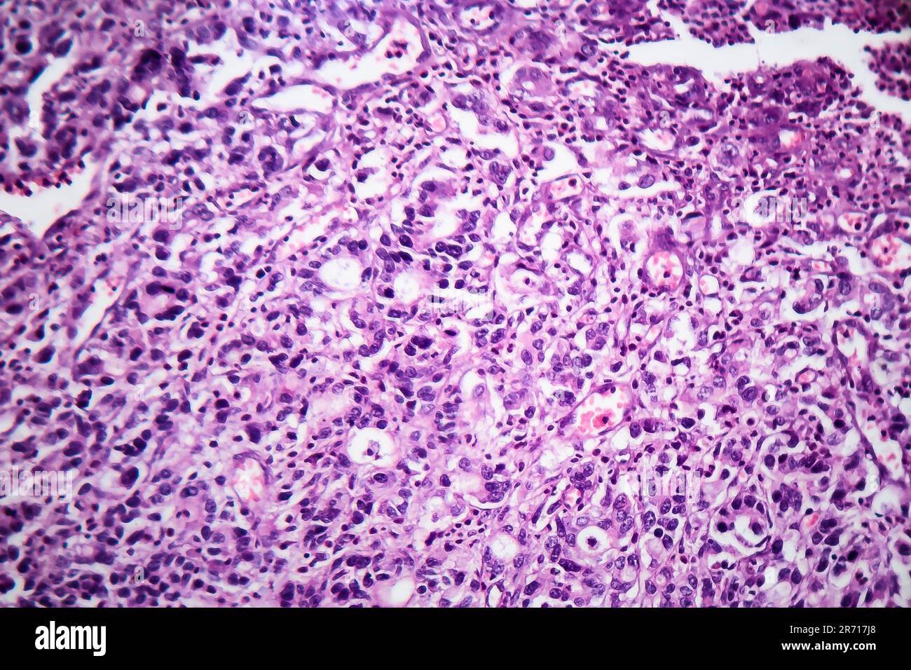 Gastric adenocarcinoma, light micrograph, photo under microscope Stock ...