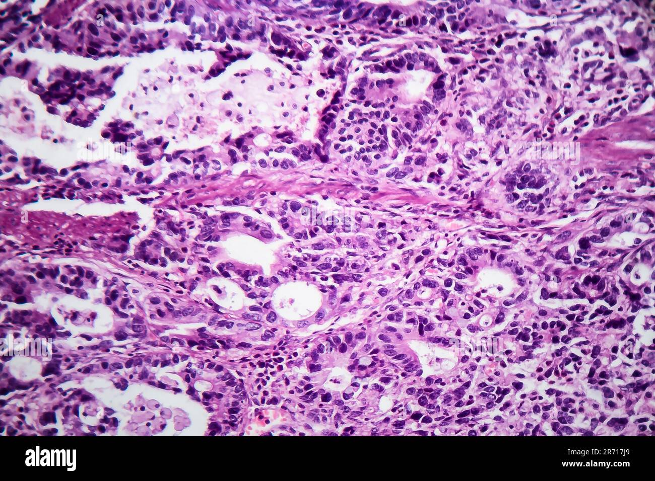 Gastric adenocarcinoma, light micrograph, photo under microscope Stock ...
