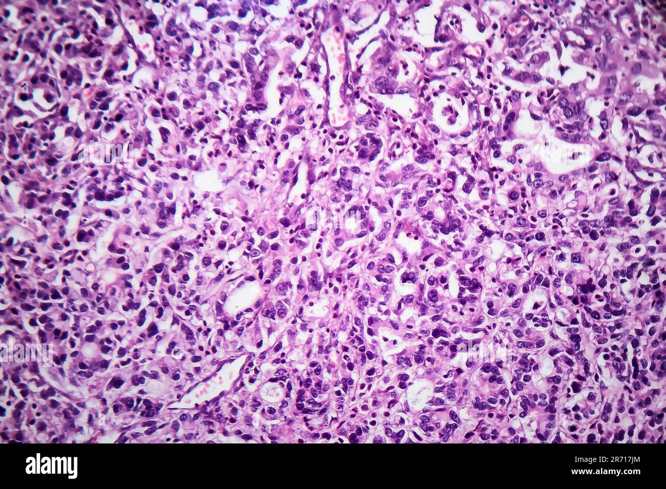 Gastric adenocarcinoma, light micrograph, photo under microscope Stock ...