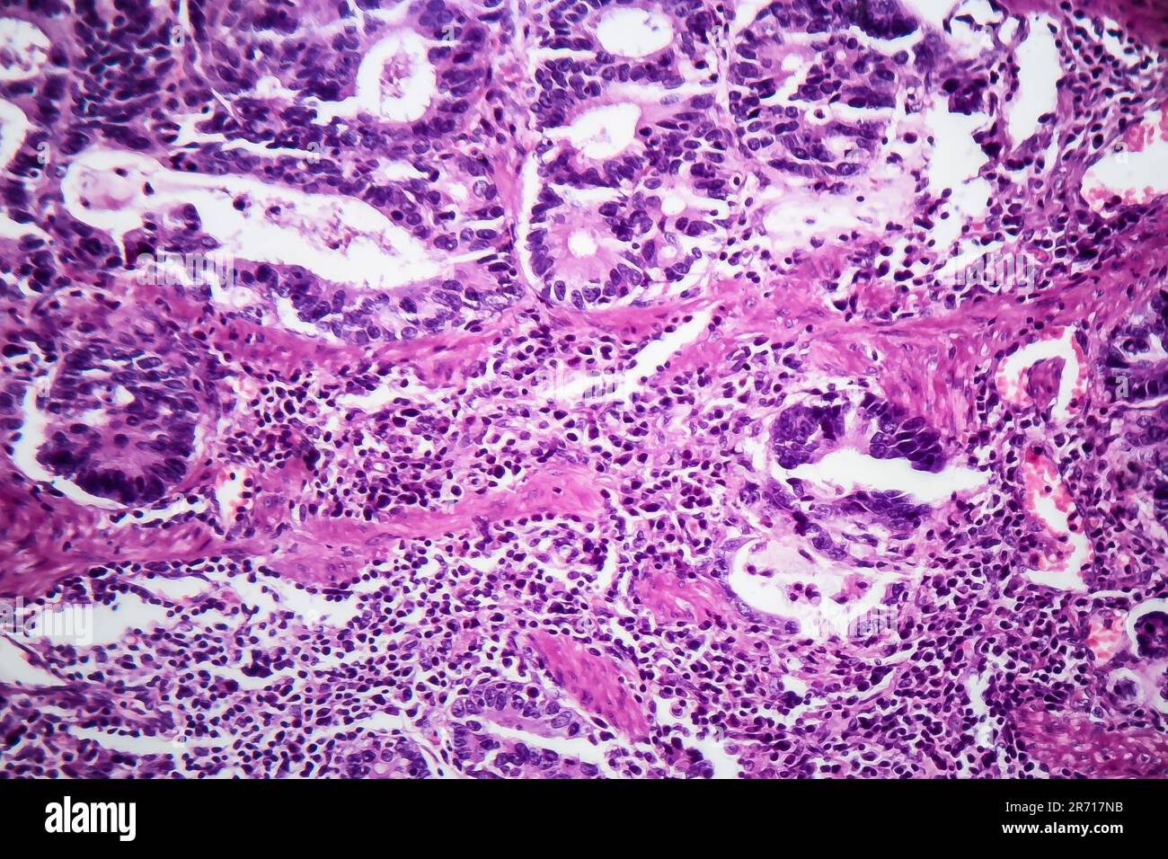 Gastric adenocarcinoma, light micrograph, photo under microscope Stock ...