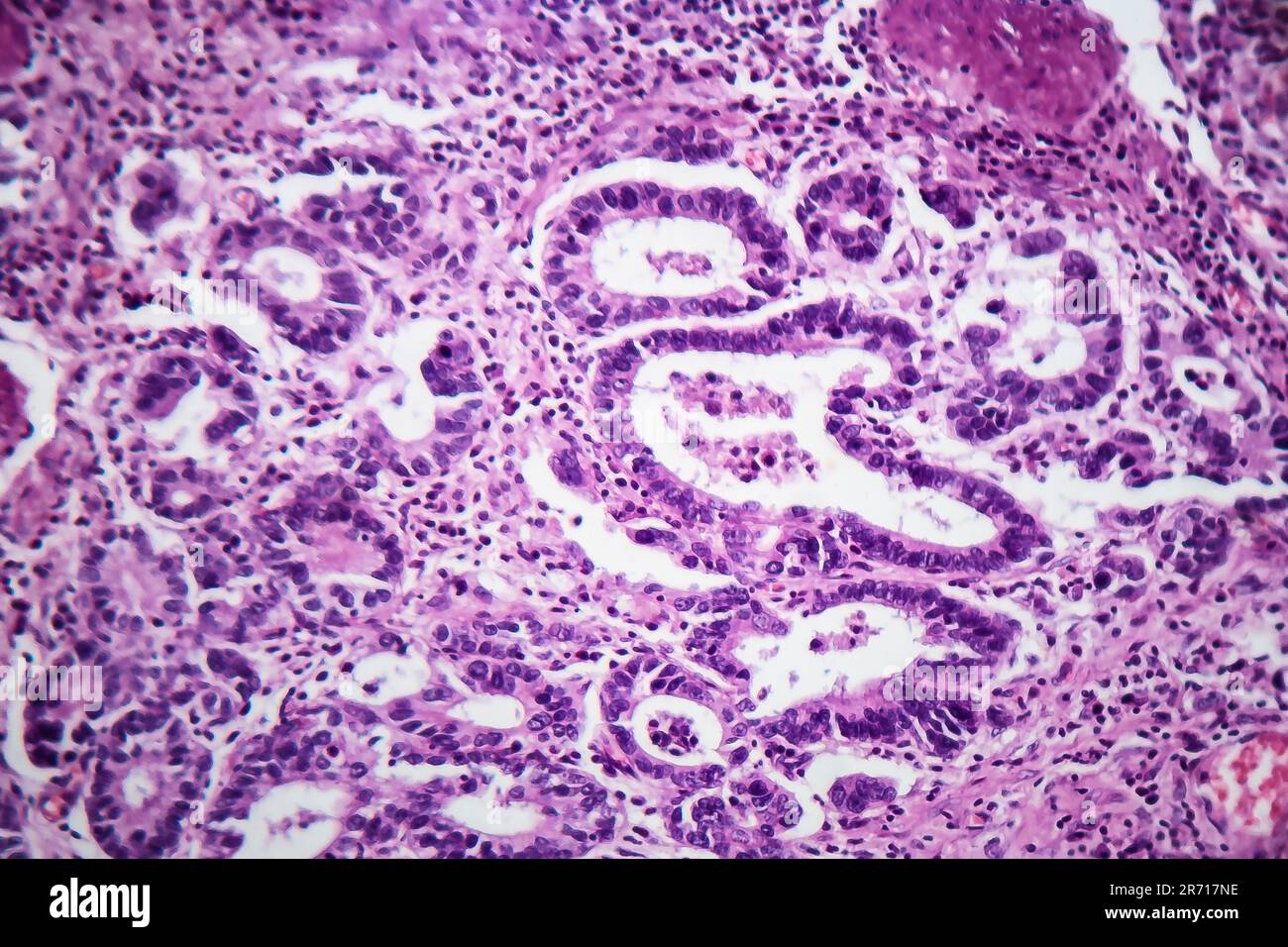 Gastric adenocarcinoma, light micrograph, photo under microscope Stock ...