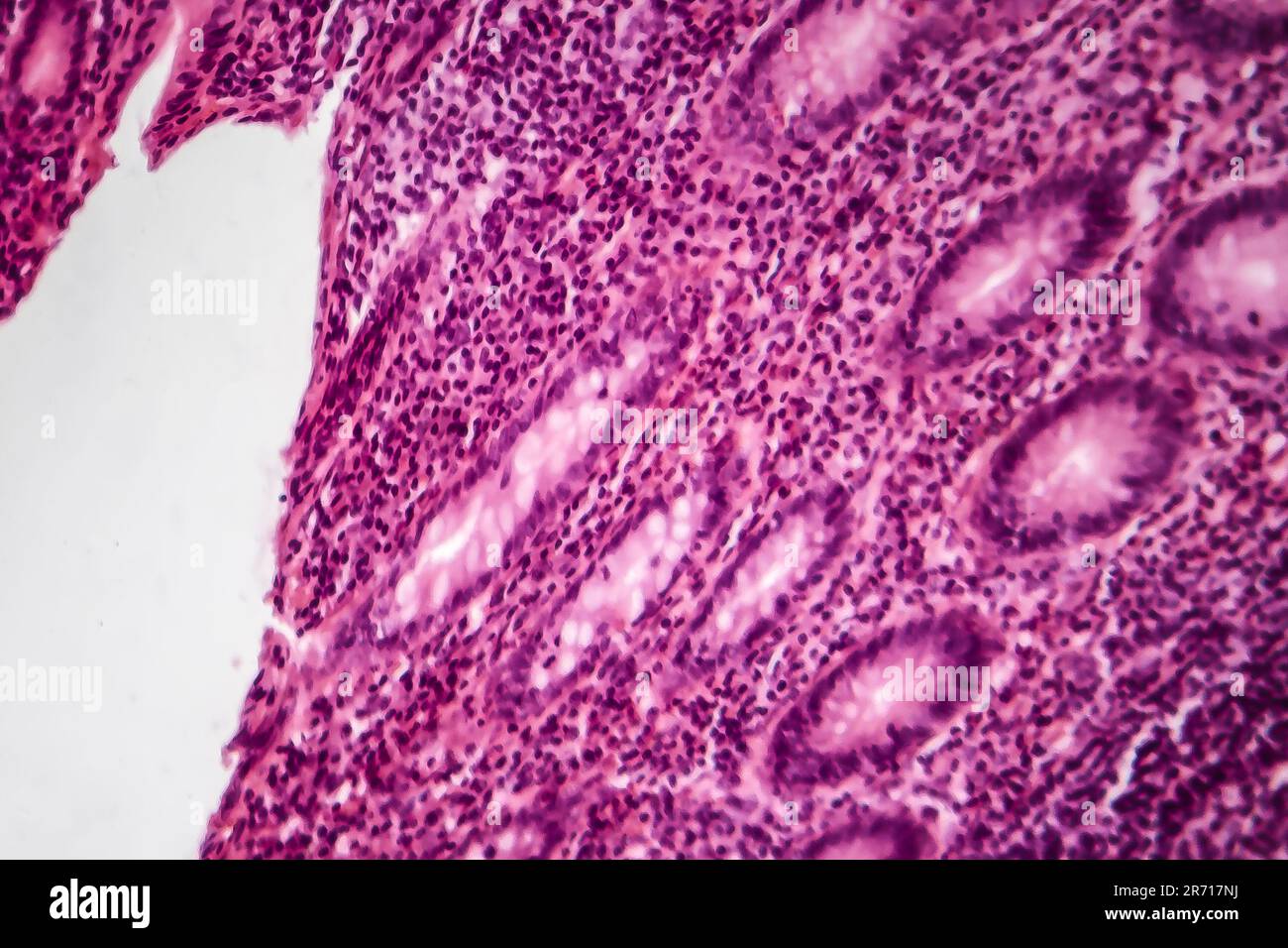 Acute simple appendicitis, light micrograph, photo under microscope ...