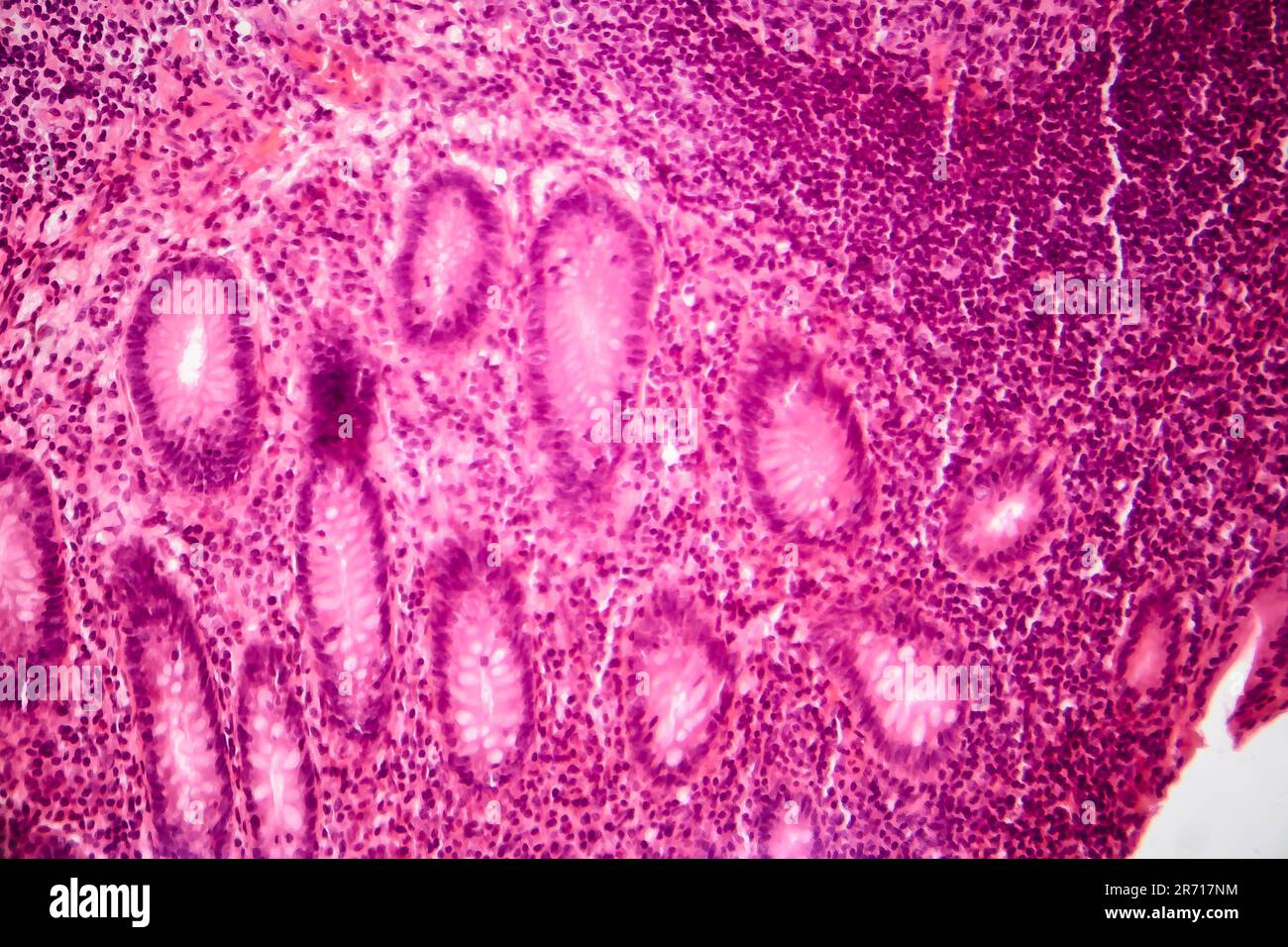 Acute simple appendicitis, light micrograph, photo under microscope ...