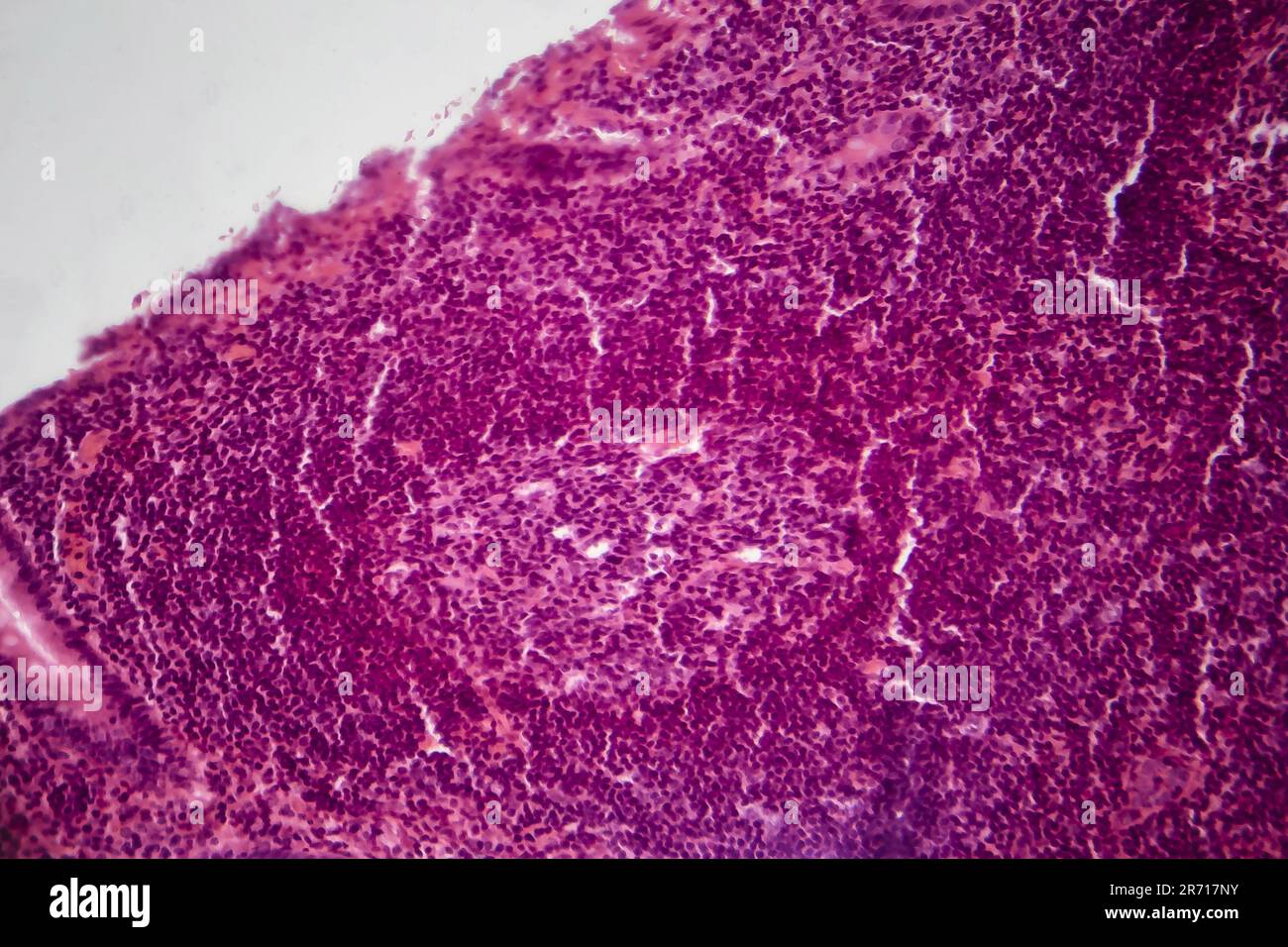 Acute simple appendicitis, light micrograph, photo under microscope ...