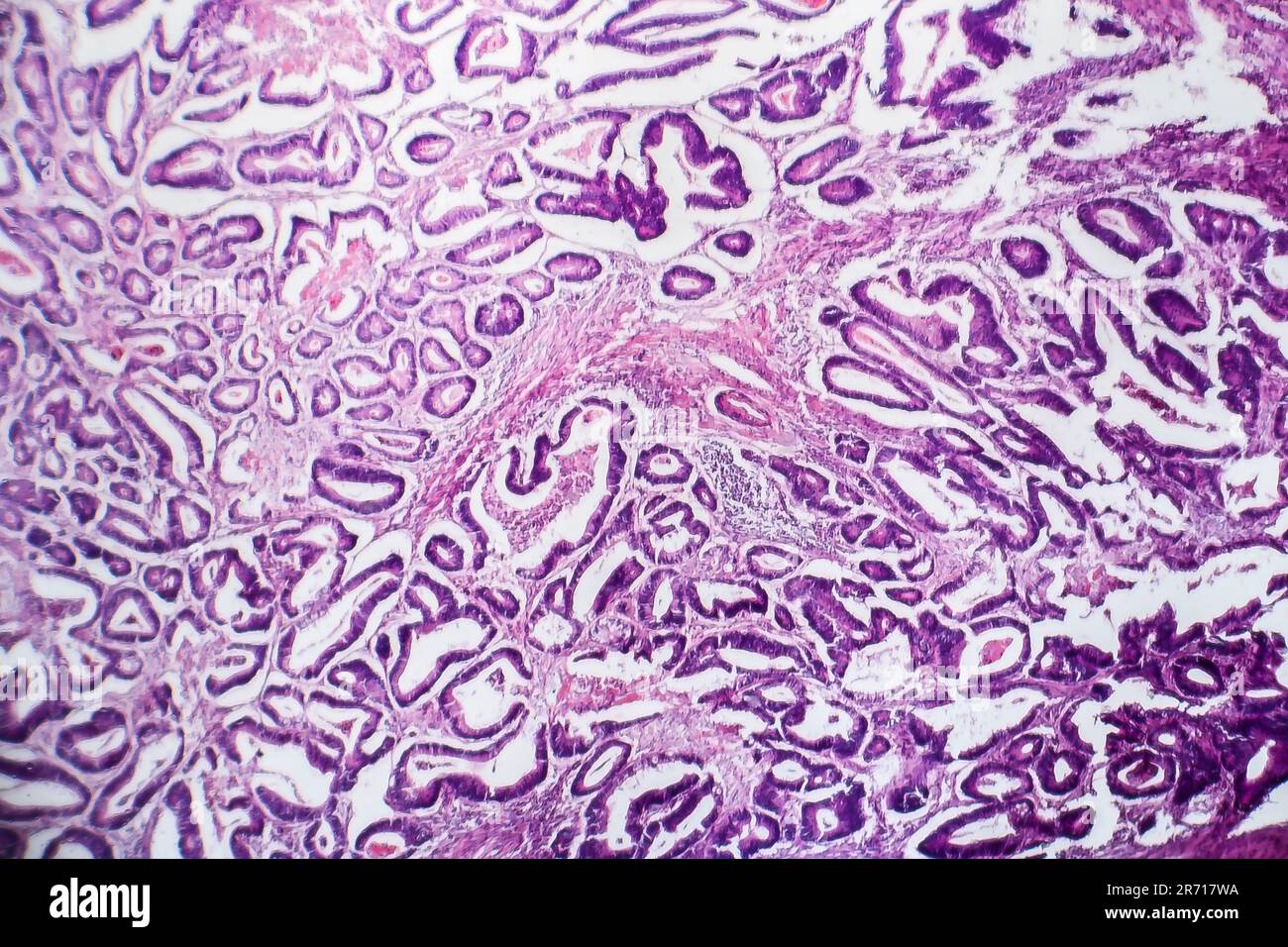 Colon cancer, light micrograph, photo under microscope Stock Photo - Alamy