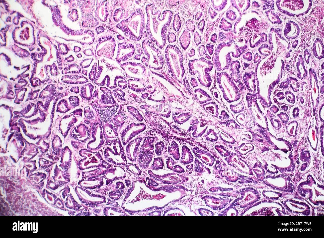 Cancer cell light micrograph hi-res stock photography and images - Alamy