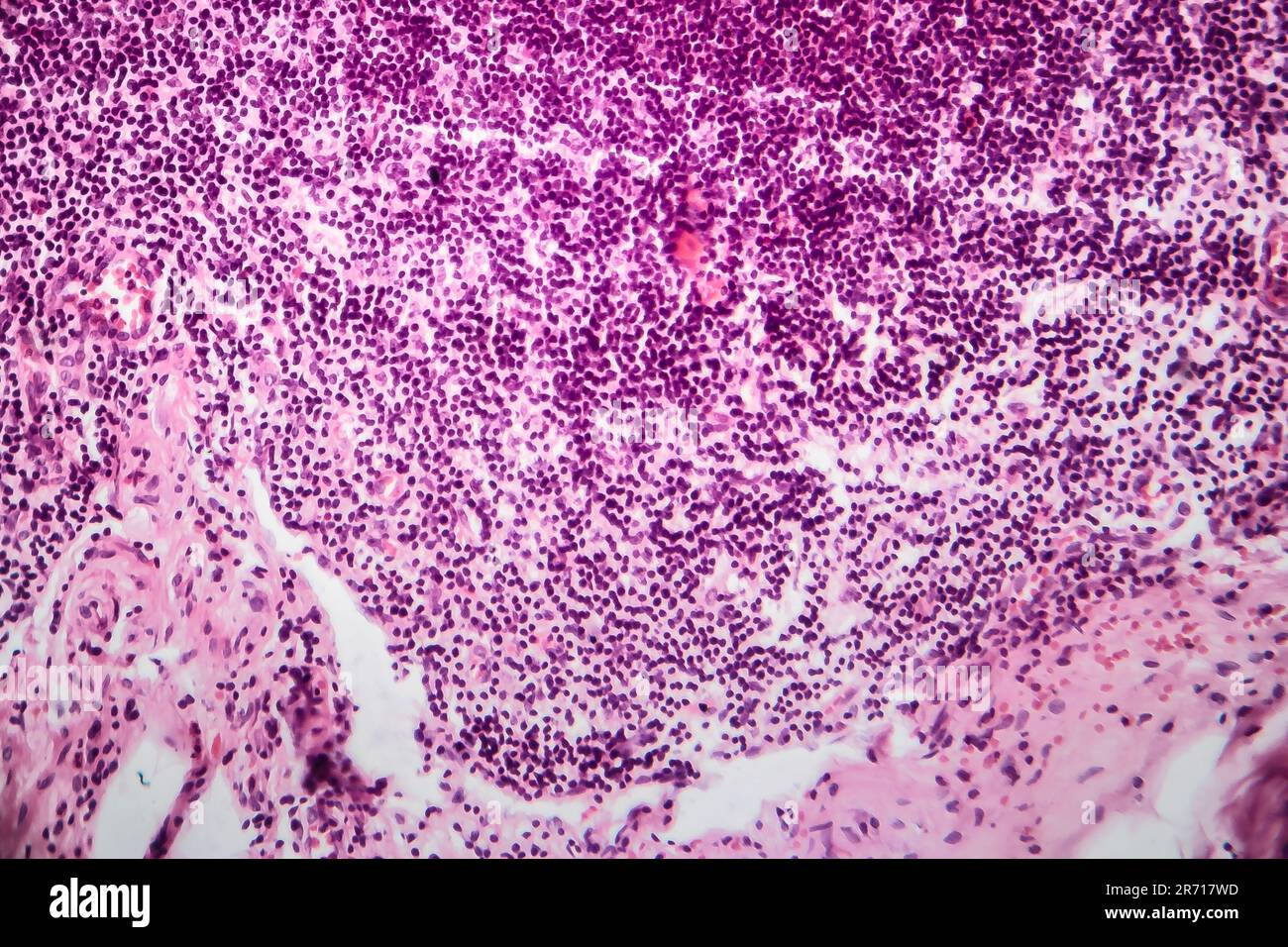 Acute simple appendicitis, light micrograph, photo under microscope ...