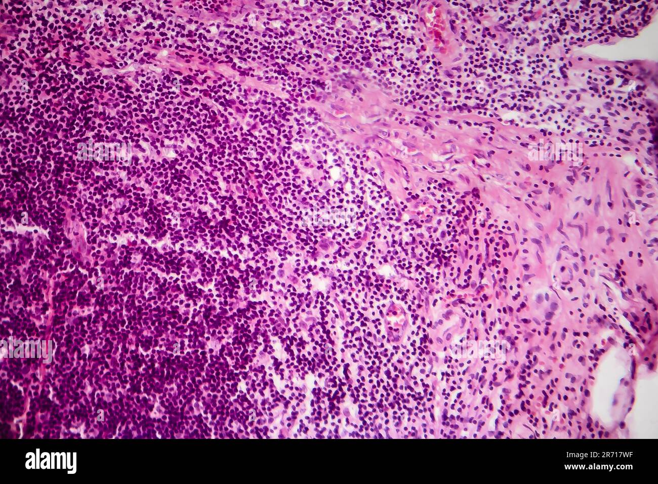 Acute simple appendicitis, light micrograph, photo under microscope ...