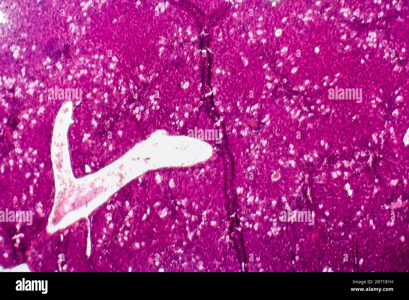 Viral hepatitis, light micrograph, photo under microscope Stock Photo ...