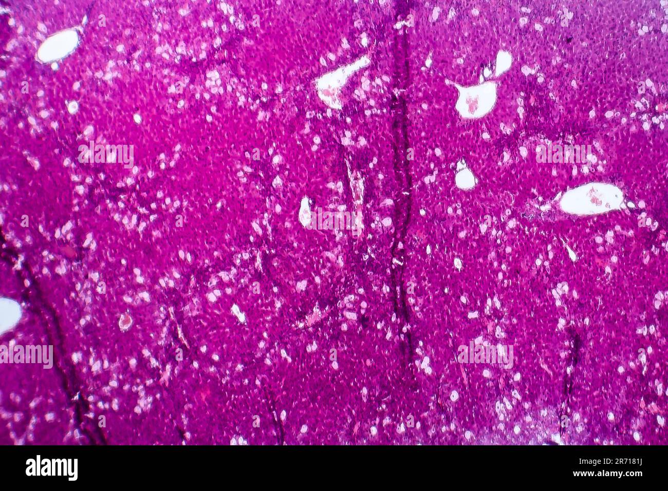 Viral hepatitis, light micrograph, photo under microscope Stock Photo ...