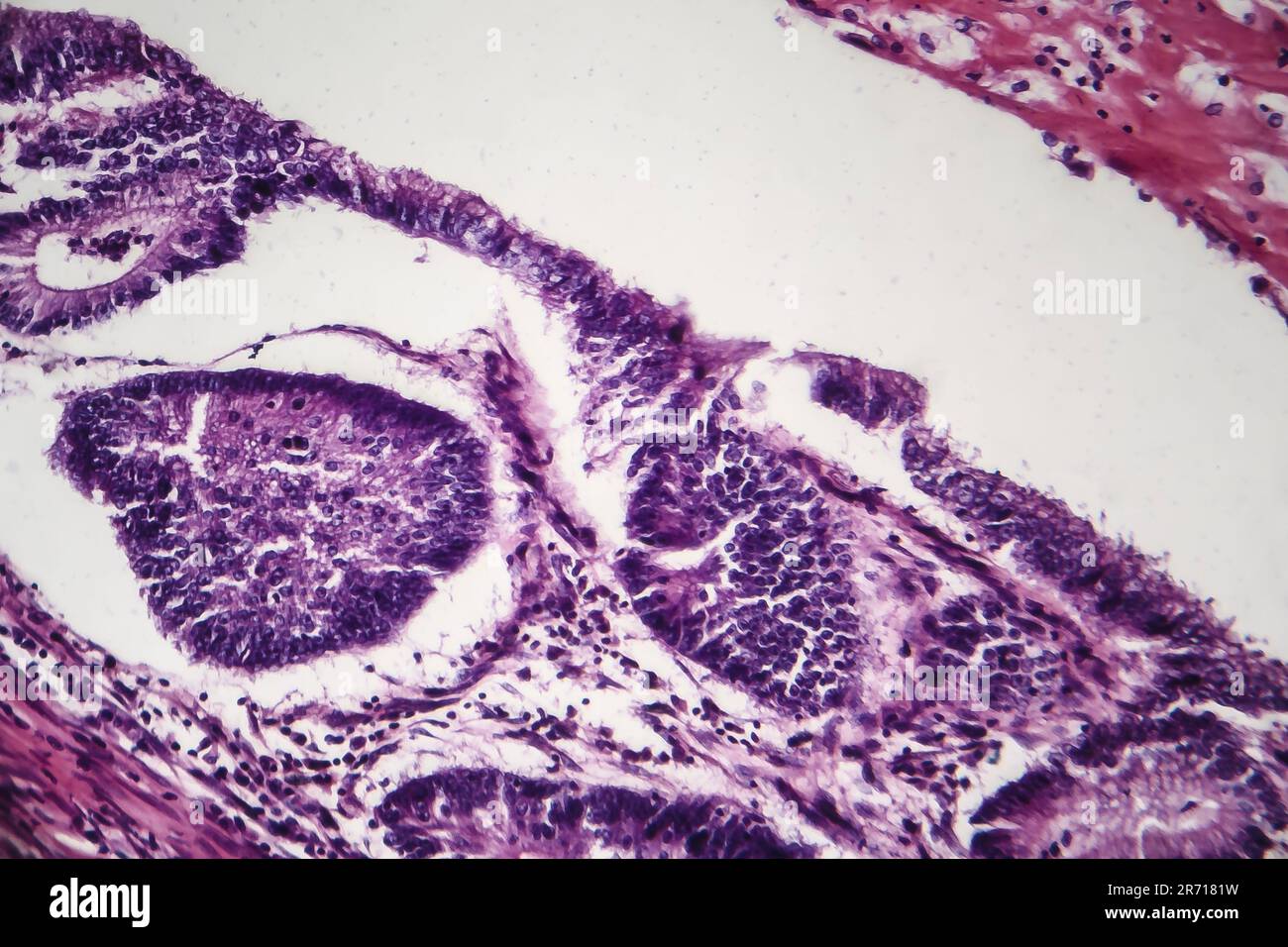 Colon cancer, light micrograph, photo under microscope Stock Photo - Alamy