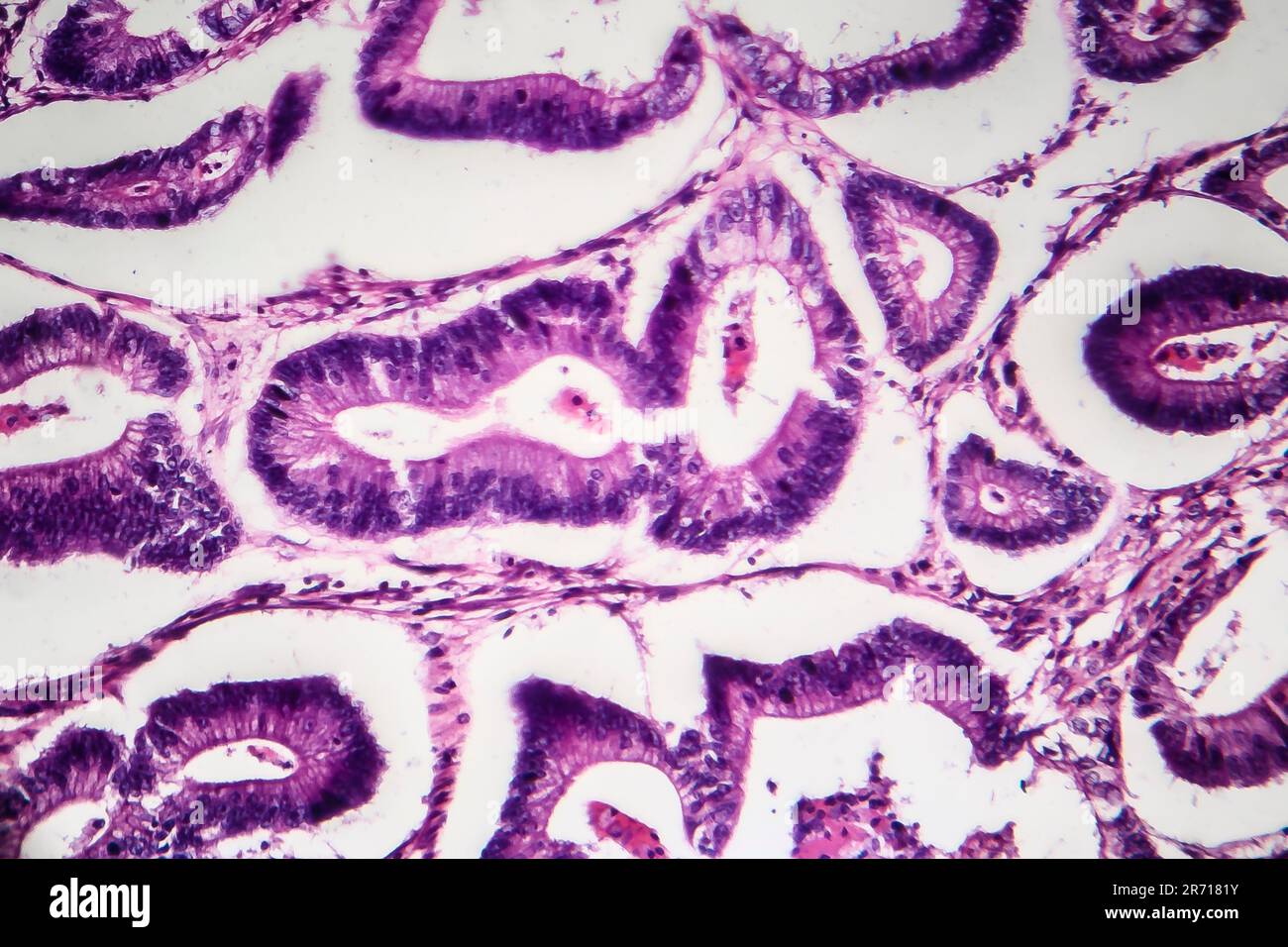 Colon cancer, light micrograph, photo under microscope Stock Photo - Alamy