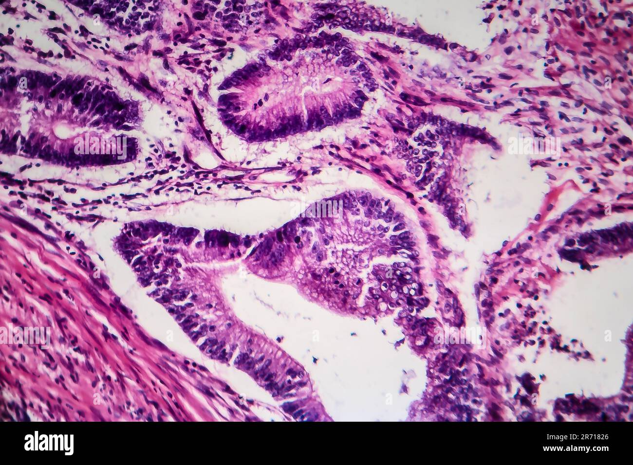 Colon cancer, light micrograph, photo under microscope Stock Photo - Alamy