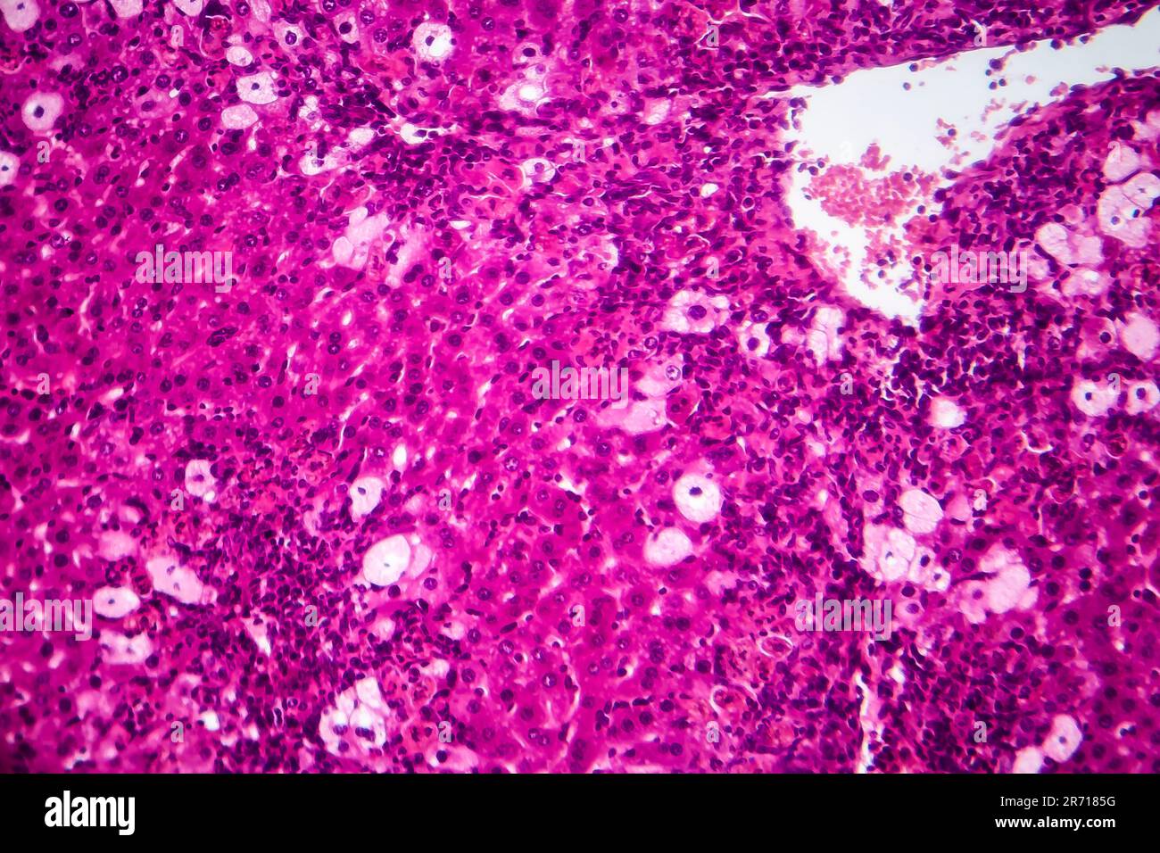 Viral hepatitis, light micrograph, photo under microscope Stock Photo ...