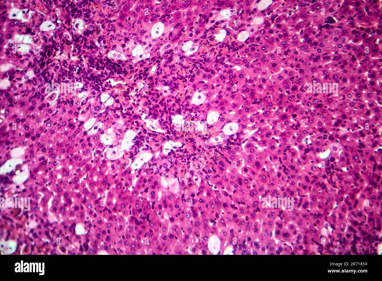 Viral hepatitis, light micrograph, photo under microscope Stock Photo ...