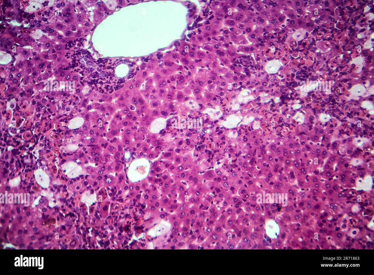 Viral hepatitis, light micrograph, photo under microscope Stock Photo ...