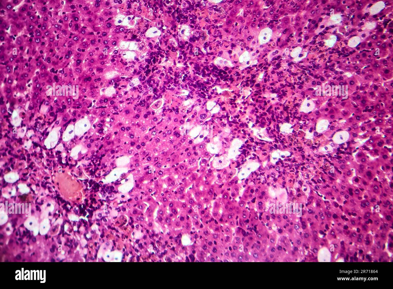 Viral hepatitis, light micrograph, photo under microscope Stock Photo ...