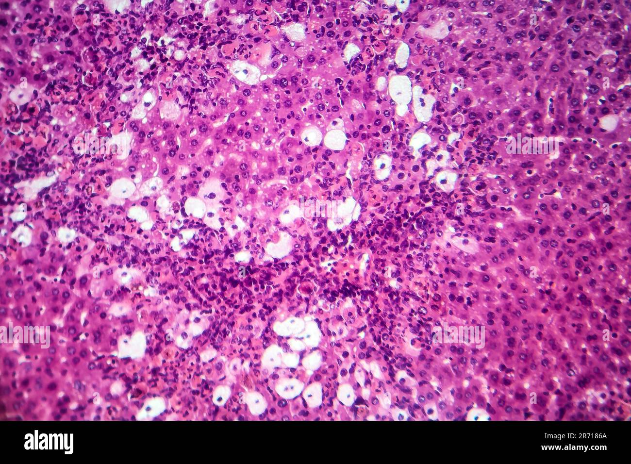 Viral hepatitis, light micrograph, photo under microscope Stock Photo ...