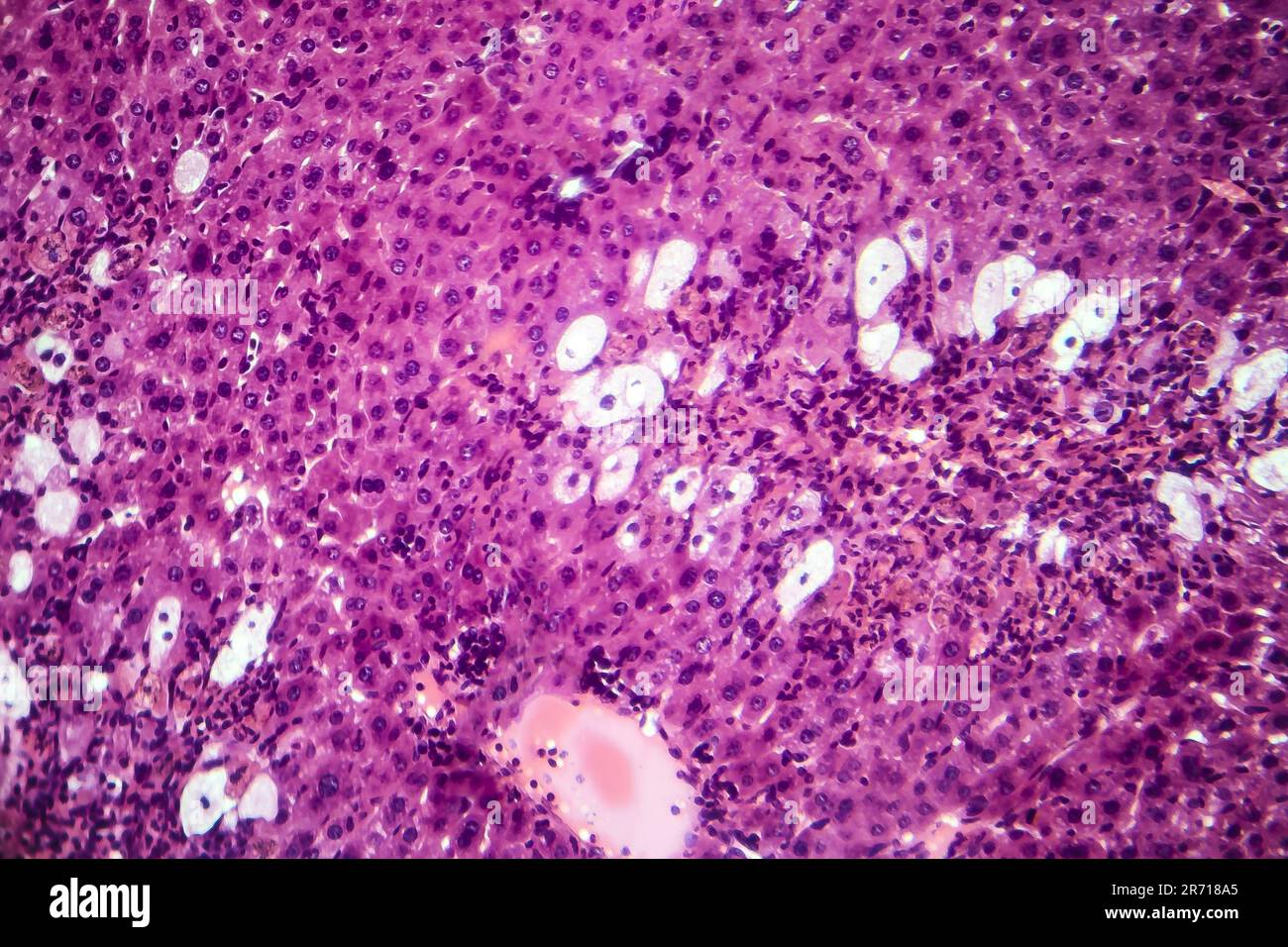 Viral hepatitis, light micrograph, photo under microscope Stock Photo ...