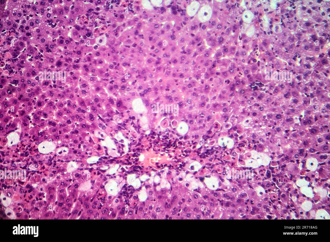 Viral hepatitis, light micrograph, photo under microscope Stock Photo ...