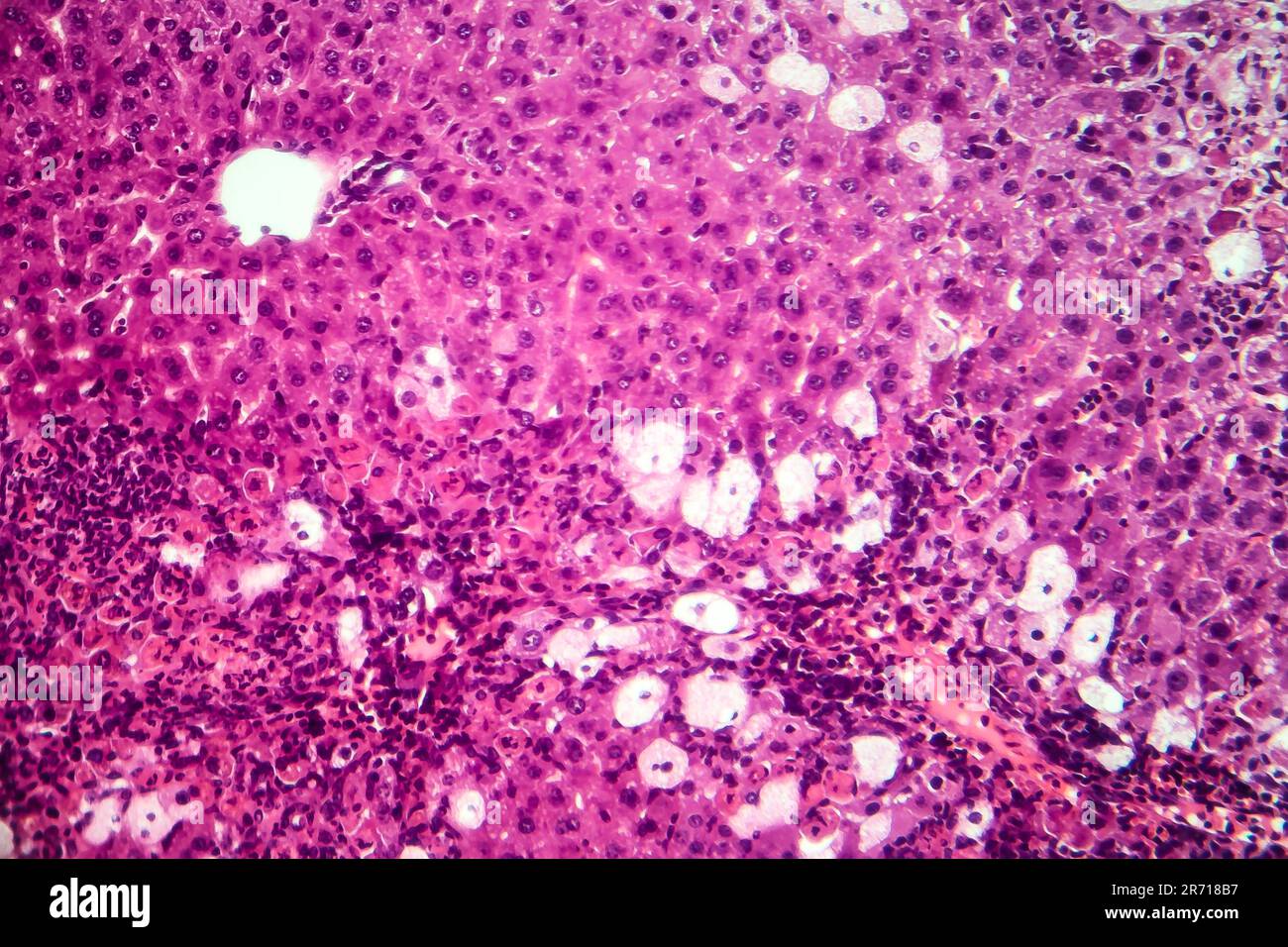 Viral hepatitis, light micrograph, photo under microscope Stock Photo ...