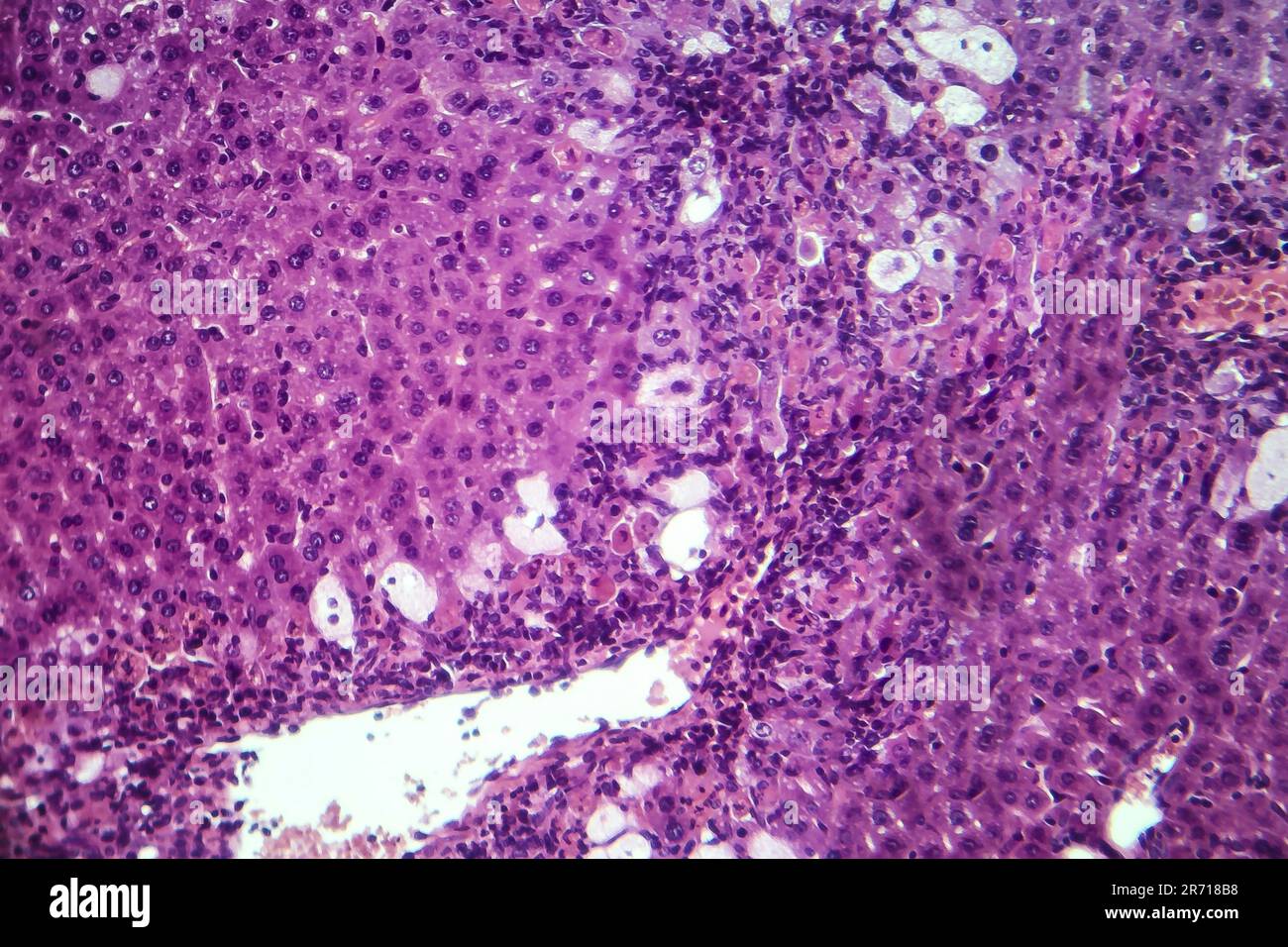 Viral hepatitis, light micrograph, photo under microscope Stock Photo ...