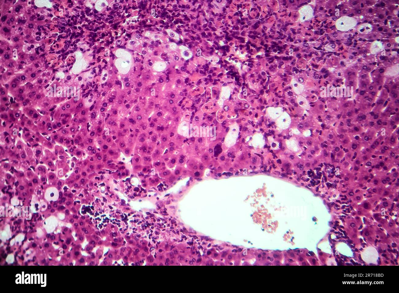 Viral hepatitis, light micrograph, photo under microscope Stock Photo ...