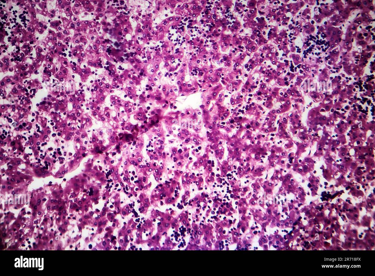 Histopathology of chronic active hepatitis, light micrograph, photo ...